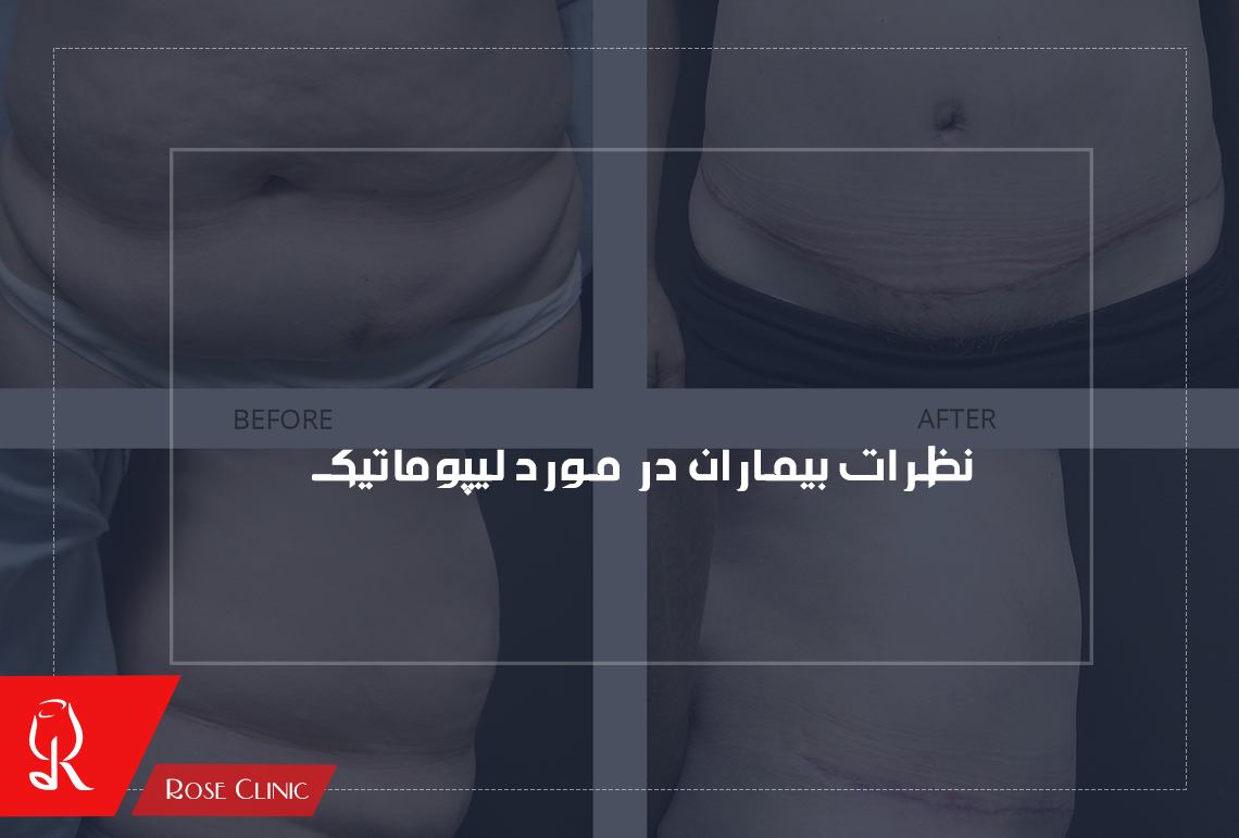 نظر بیماران در مورد لیپوماتیک و همه چیز درباره لیپوماتیک • کلینیک رز