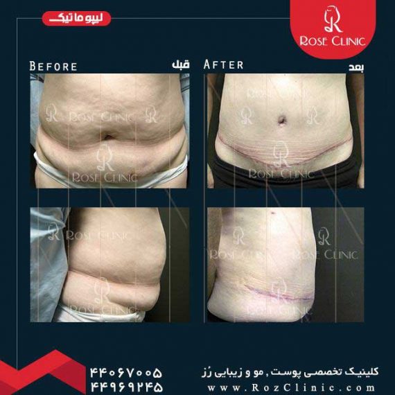 لیپوماتیک • کلینیک رز