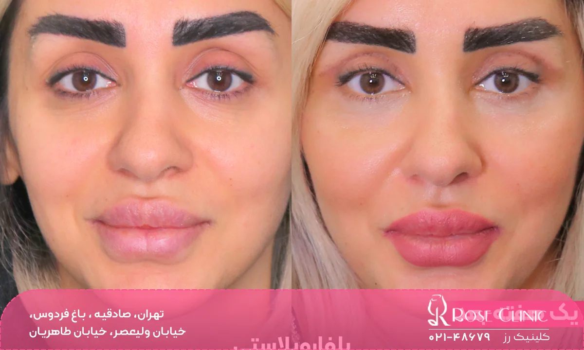 بلفاروپلاستی • کلینیک رز